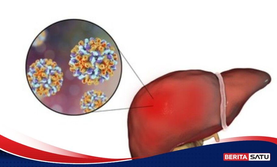 Hepatitis Akut di Indonesia Bertambah Jadi 16 Orang Hepatitis Akut di Indonesia Bertambah Jadi 16 Orang